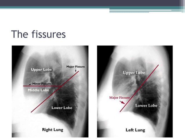 Chest x ray positioning | PPTX | Lung and Respiratory Health | Diseases ...