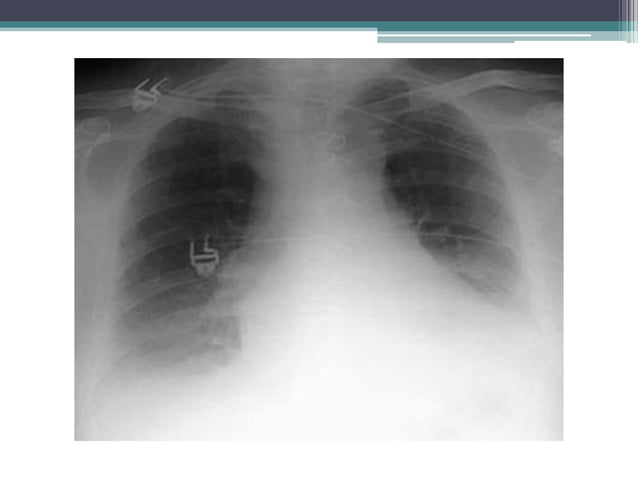 Chest x ray positioning | PPTX | Lung and Respiratory Health | Diseases ...