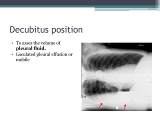 Chest x ray positioning | PPTX