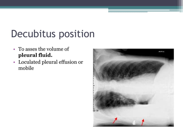 Chest x ray positioning | PPTX | Lung and Respiratory Health | Diseases ...