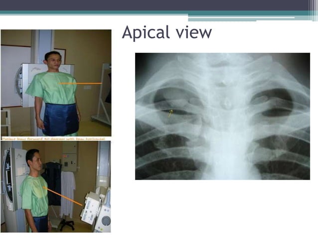 Chest x ray positioning | PPTX | Lung and Respiratory Health | Diseases ...