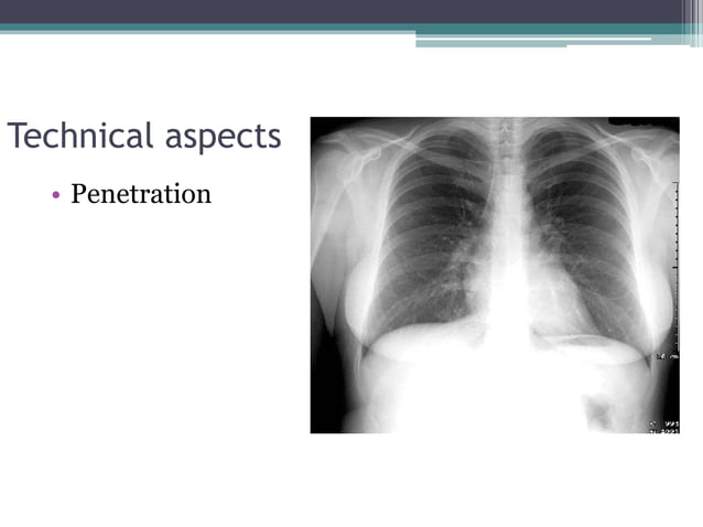 Chest x ray positioning | PPTX | Lung and Respiratory Health | Diseases ...