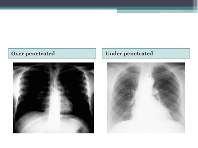 Chest x ray positioning | PPTX | Lung and Respiratory Health | Diseases ...