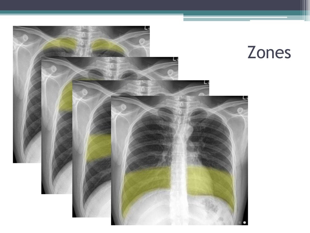 Chest x ray positioning