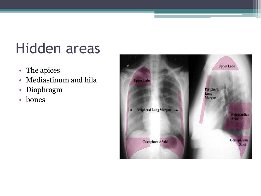 Chest x ray positioning