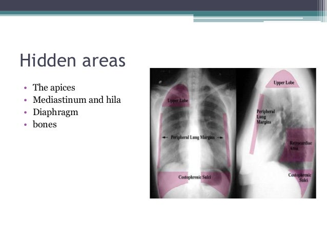 Chest x ray positioning
