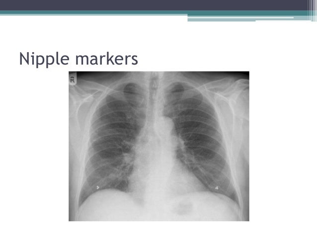 Chest x ray positioning