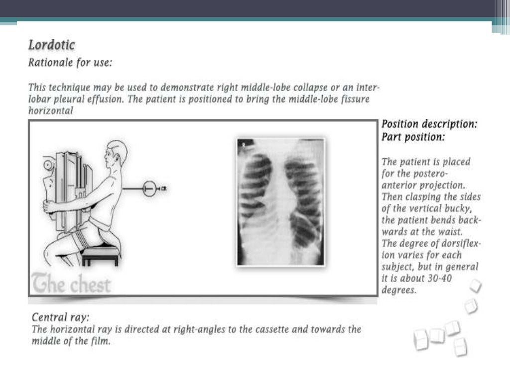 Chest x ray positioning