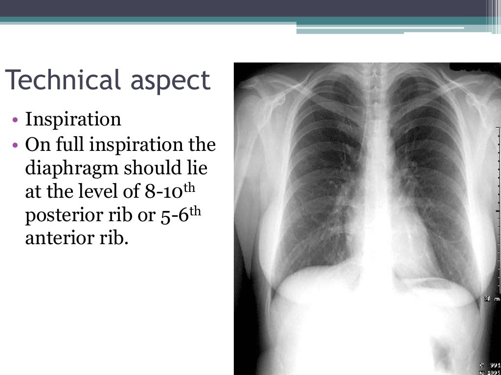 Chest x ray positioning