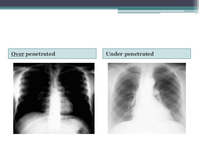 Chest x ray positioning