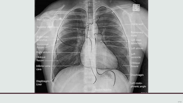 Chest X-Ray presentation.pptx