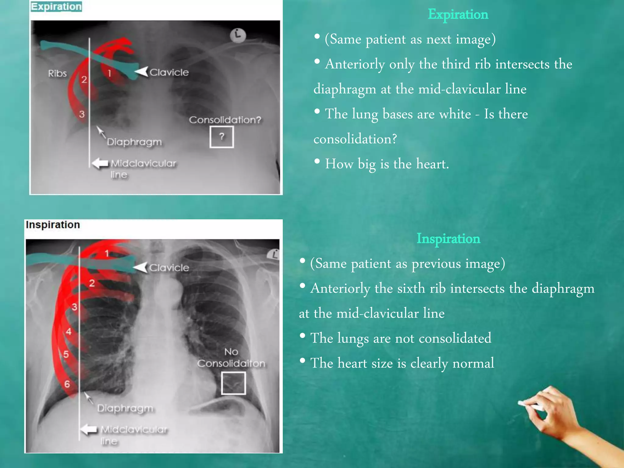 Chest x ray quality - how to interpret chest x-ray (1) | PPTX
