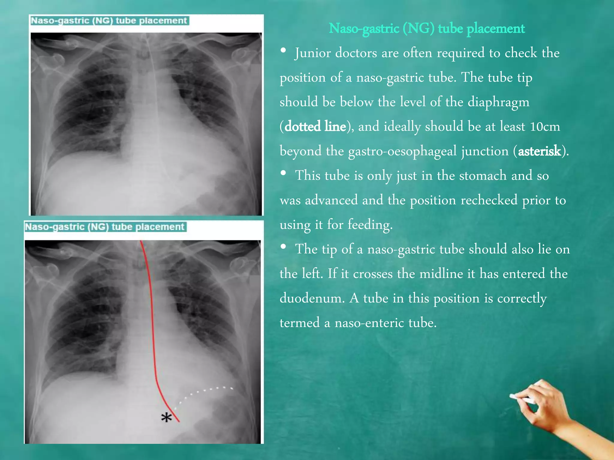 Chest x ray quality - how to interpret chest x-ray (1) | PPTX