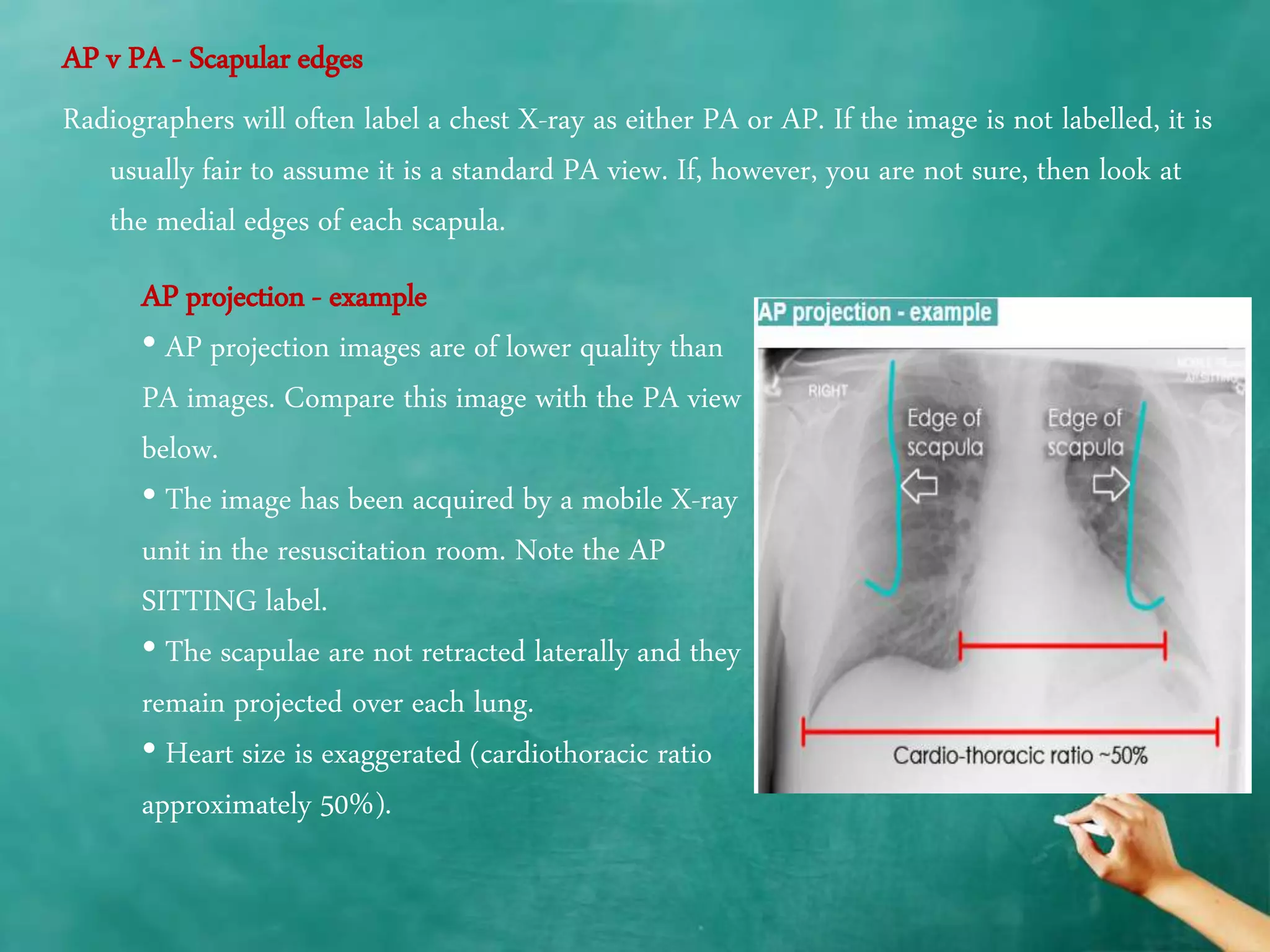 Chest x ray quality - how to interpret chest x-ray (1) | PPTX