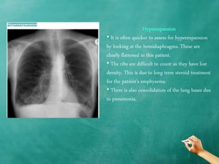 Chest x ray quality - how to interpret chest x-ray (1) | PPTX