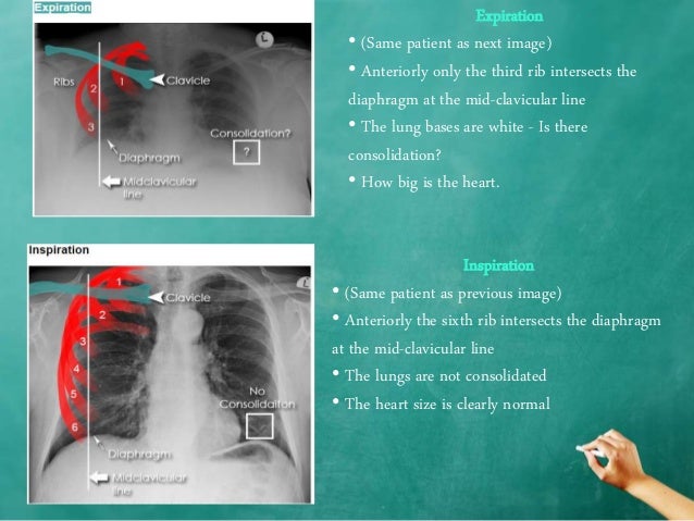 Chest x ray quality - how to interpret chest x-ray (1)