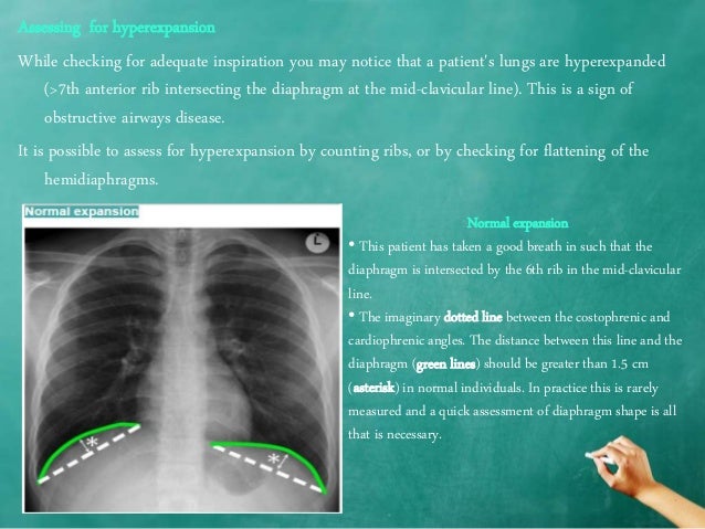 Chest x ray quality - how to interpret chest x-ray (1)