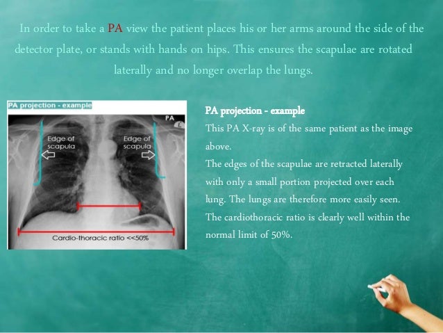 Chest x ray quality - how to interpret chest x-ray (1)