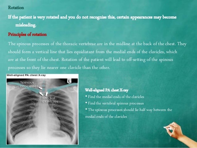 Chest x ray quality - how to interpret chest x-ray (1)
