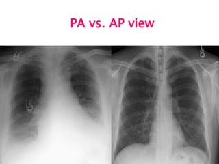 Chest X-ray radiology_Power Point Presentation | PPTX