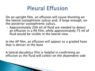 Chest X-ray radiology_Power Point Presentation | PPTX
