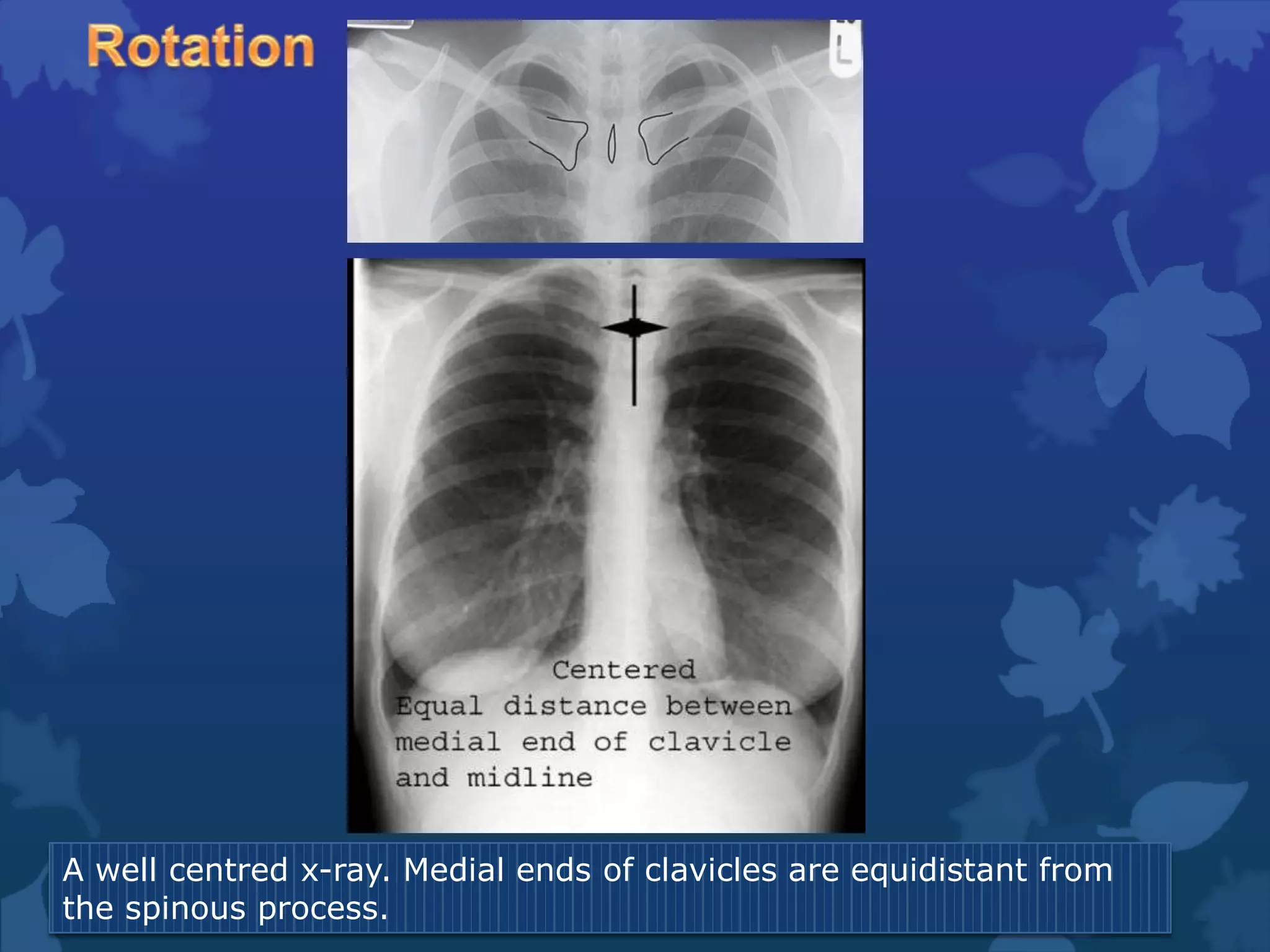 Chest x ray review. | PPTX