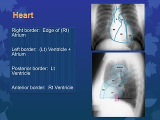 Chest x ray review. | PPTX