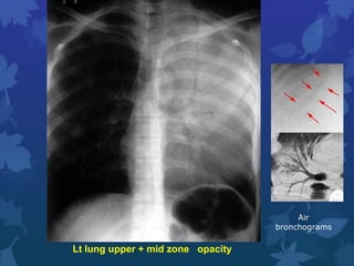 Chest x ray review. | PPTX
