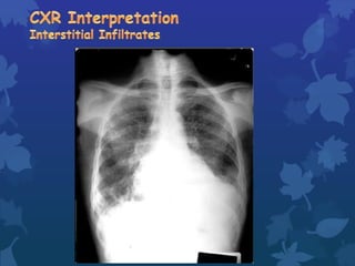 Chest x ray review. | PPTX