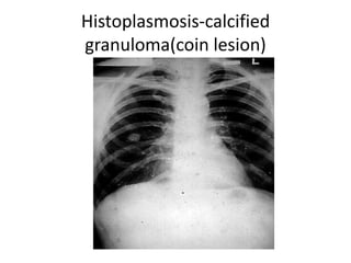 Histoplasmosis Lung X Ray