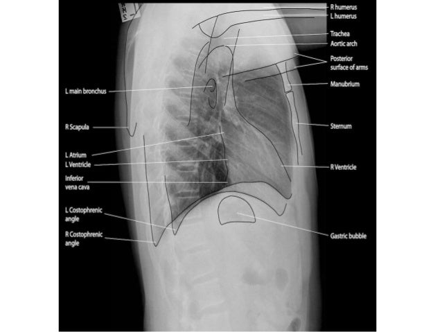 Chest x rays