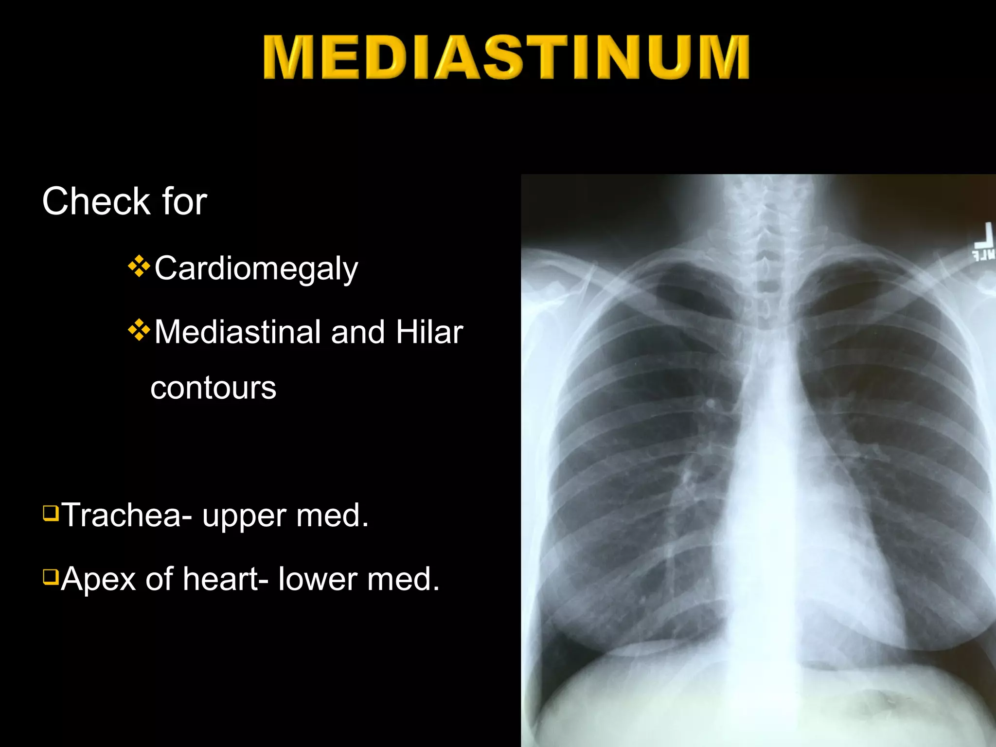 Chest x rays | PPT
