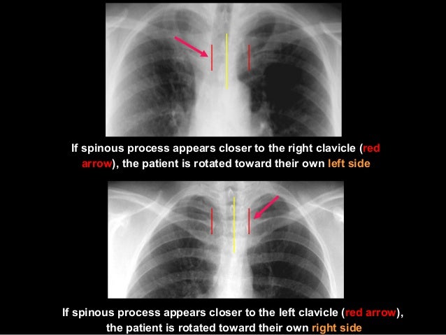 Chest x rays