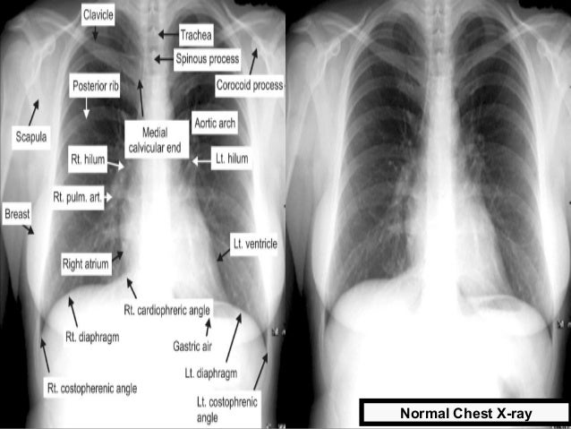 Chest x rays
