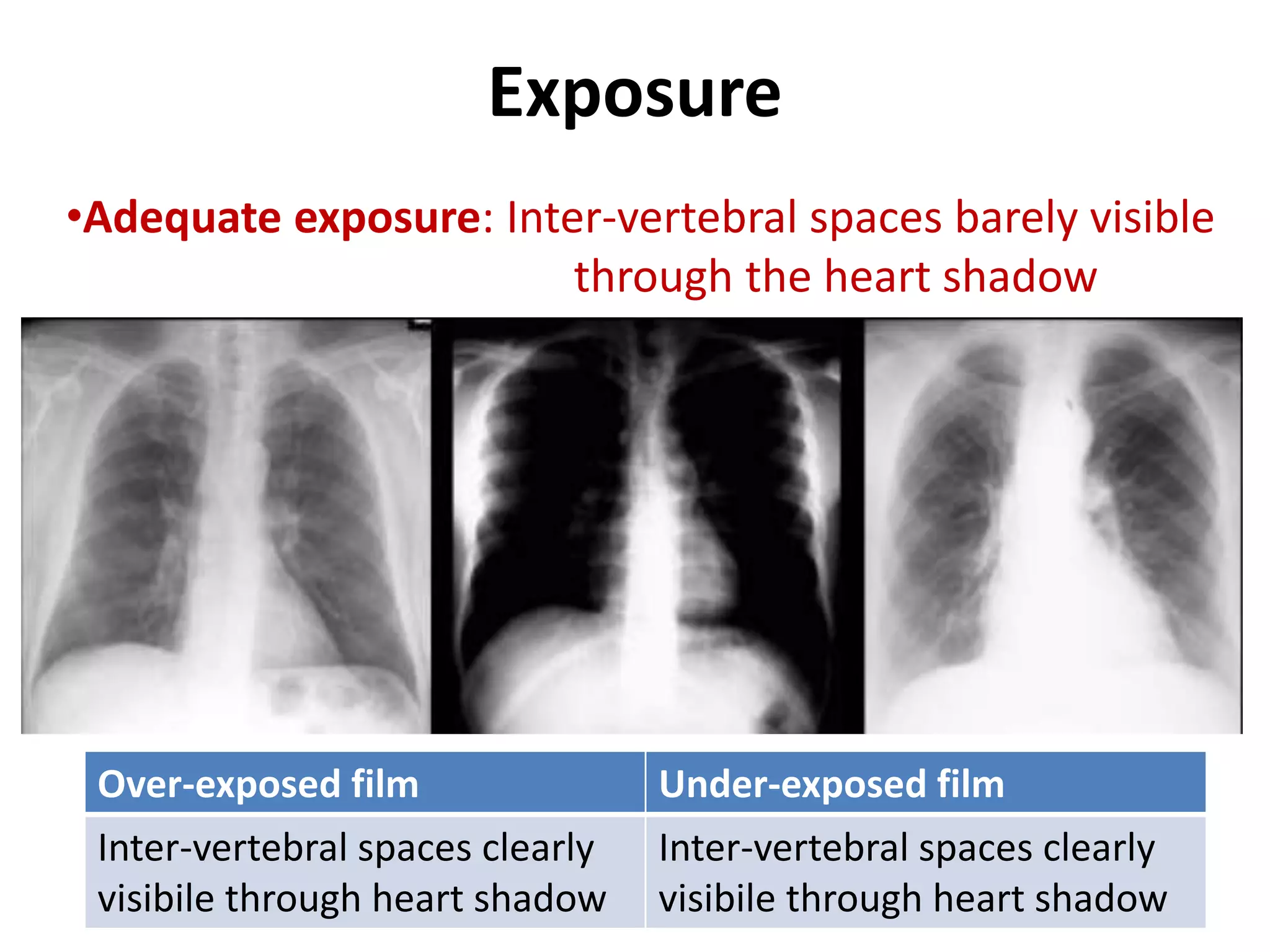 Chest X-rays for Undergraduates | PPTX