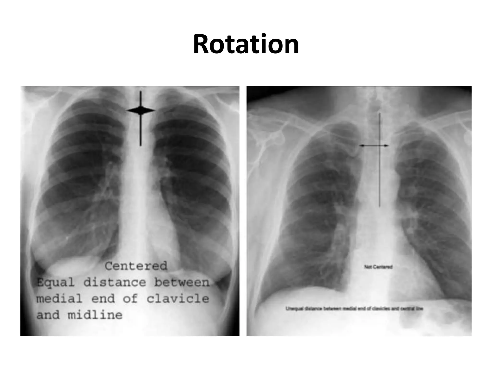 Chest X-rays for Undergraduates | PPTX