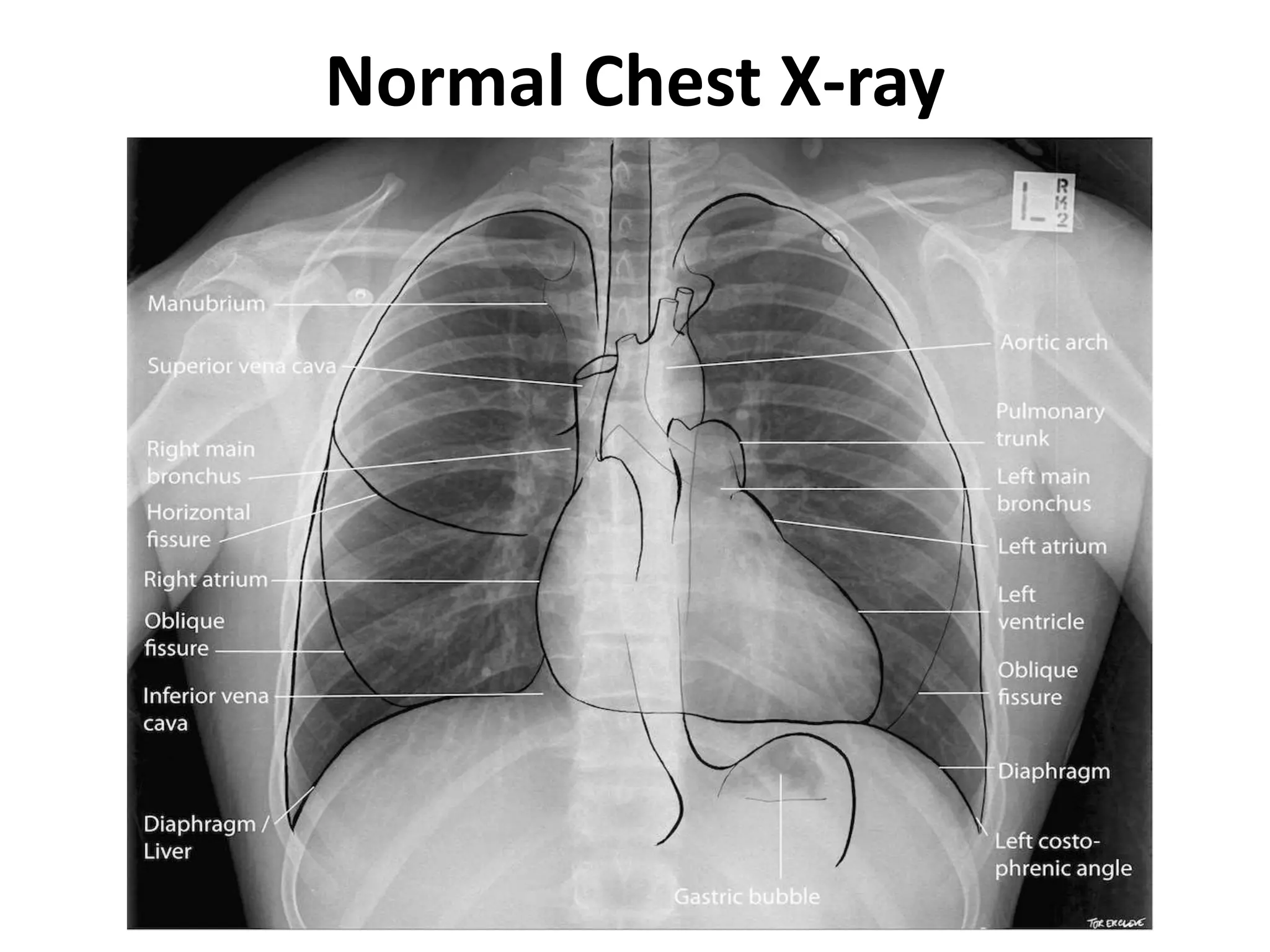 Chest X-rays for Undergraduates | PPTX
