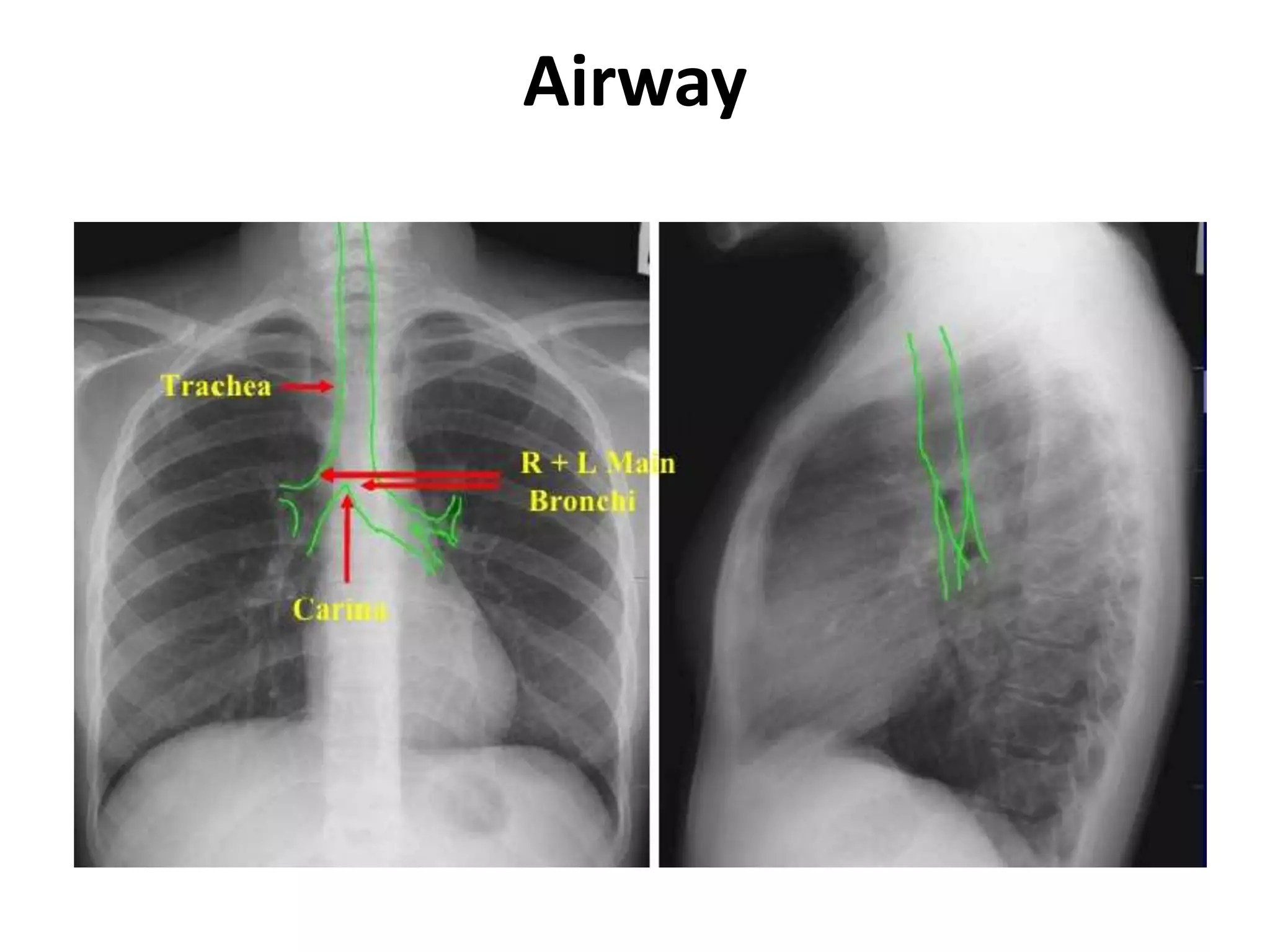 Chest X-rays for Undergraduates | PPTX