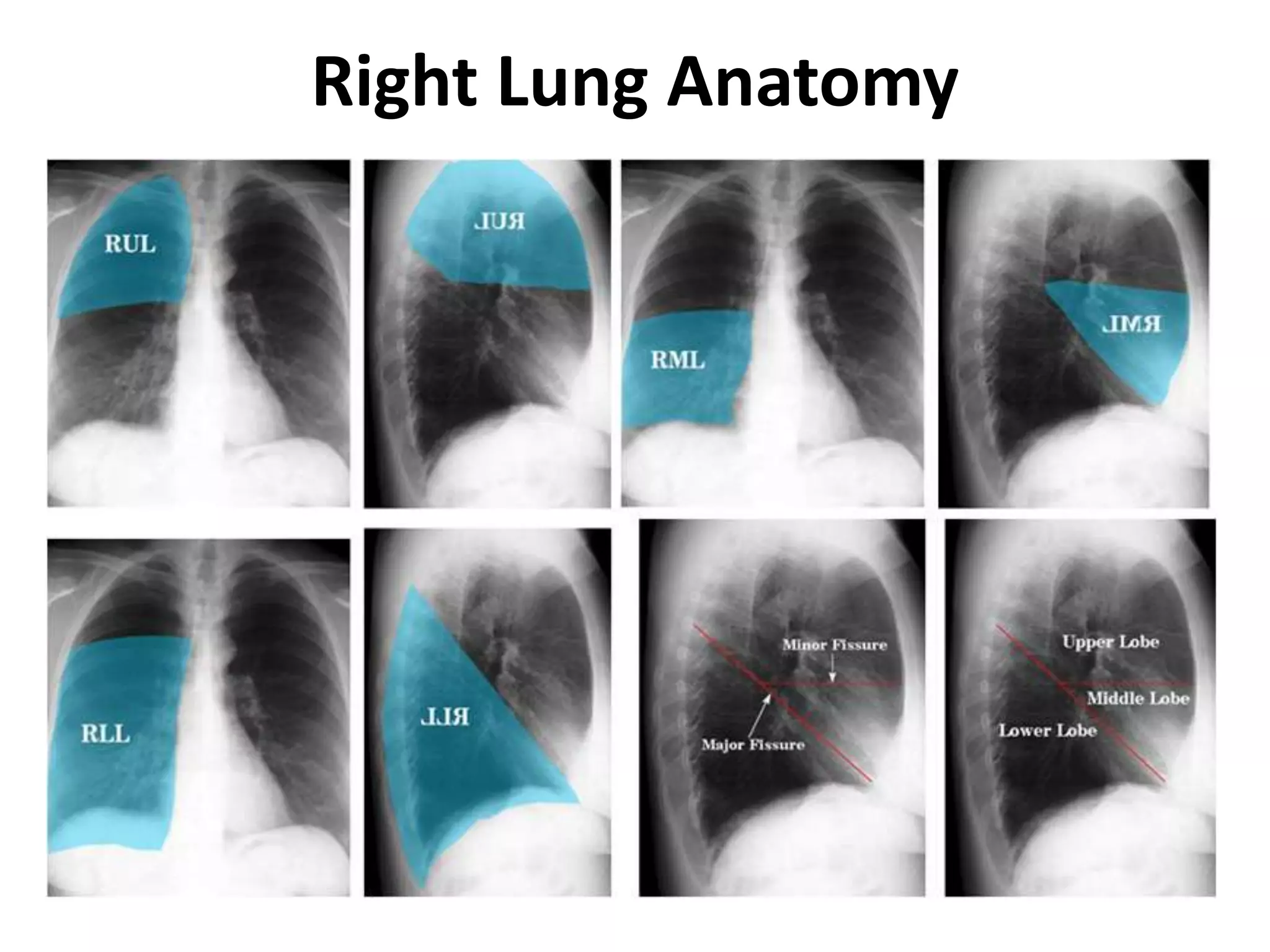 Chest X-rays for Undergraduates | PPTX