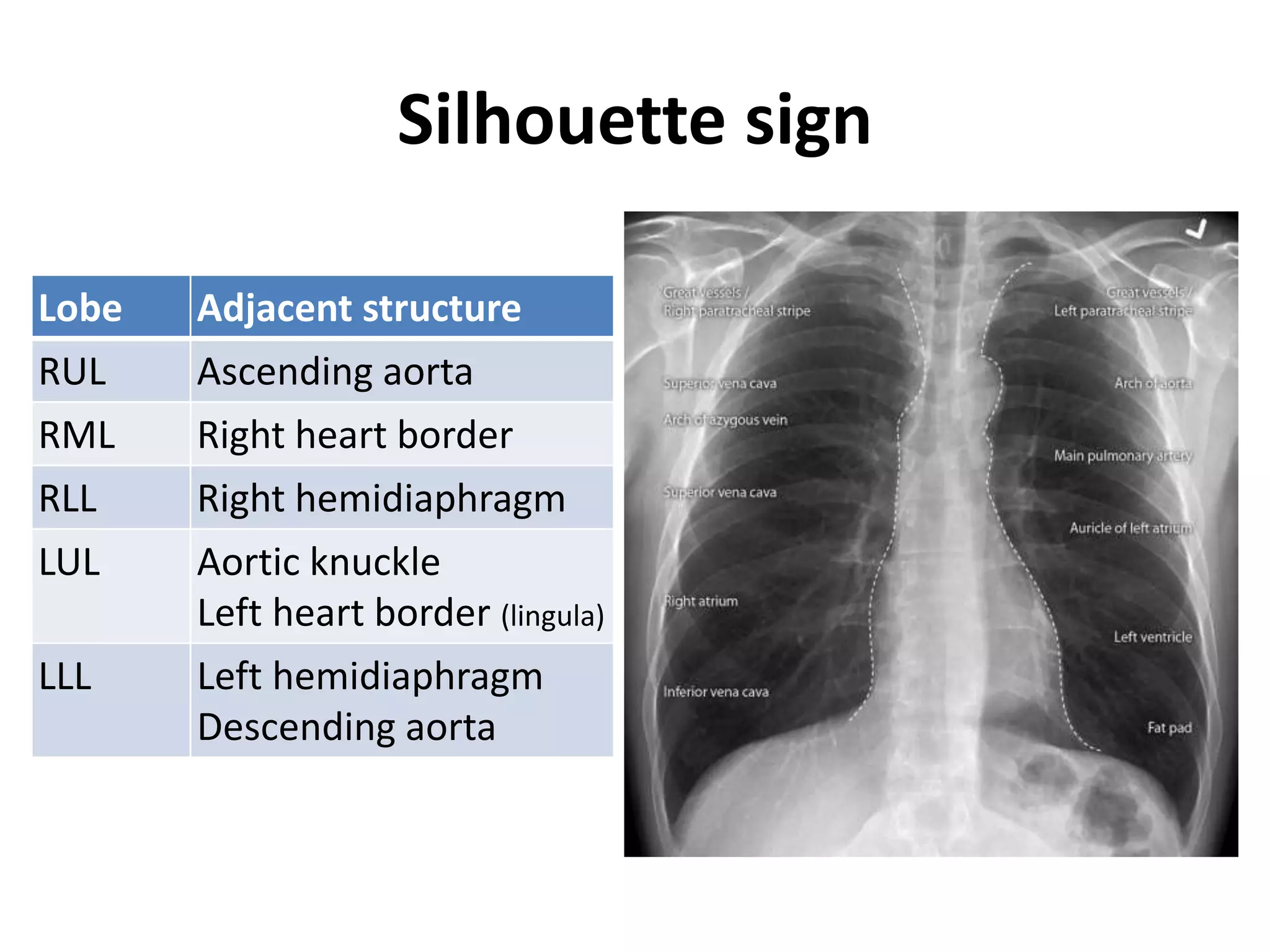 Chest X-rays for Undergraduates | PPTX