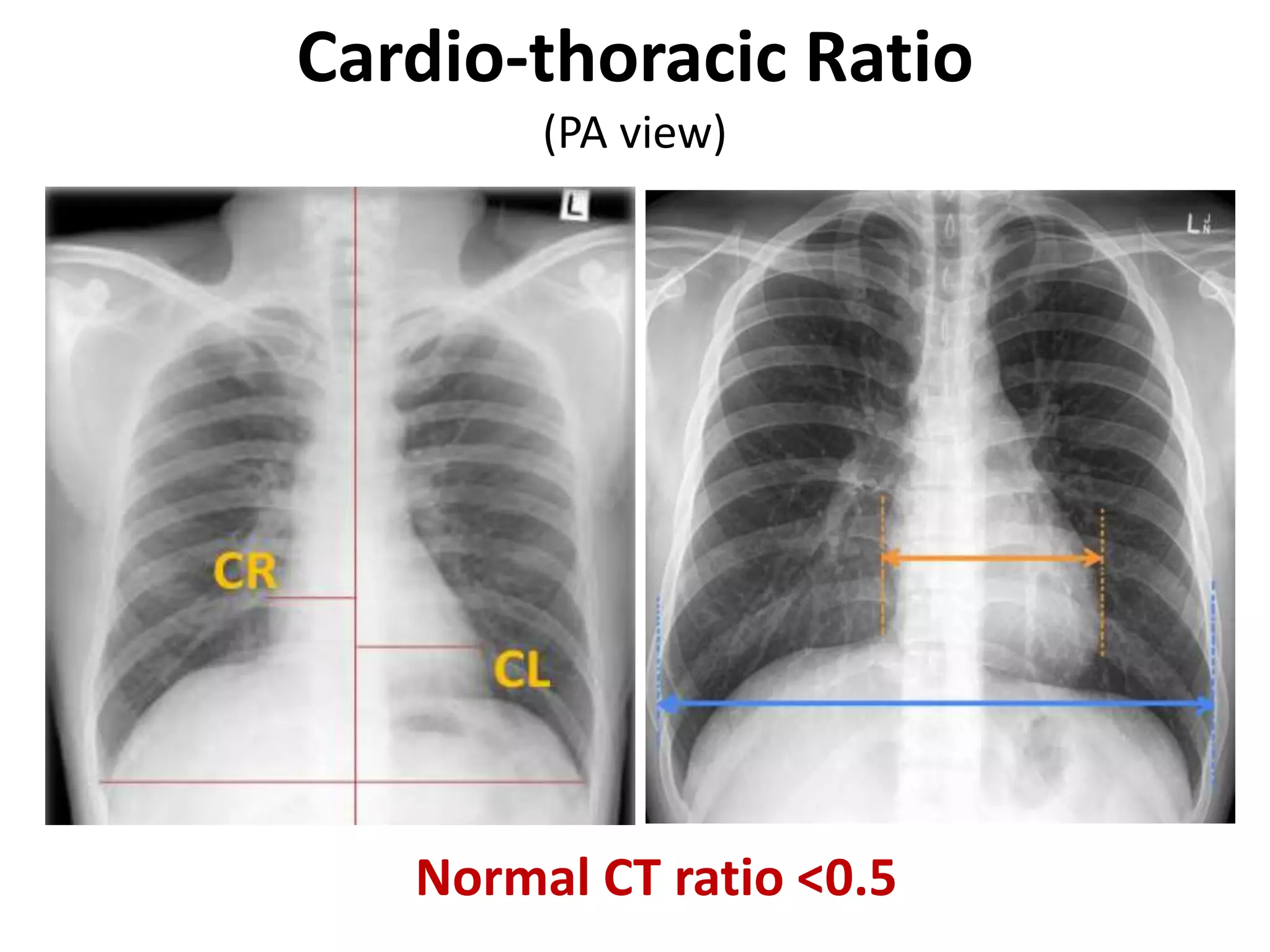 Chest X-rays for Undergraduates | PPTX