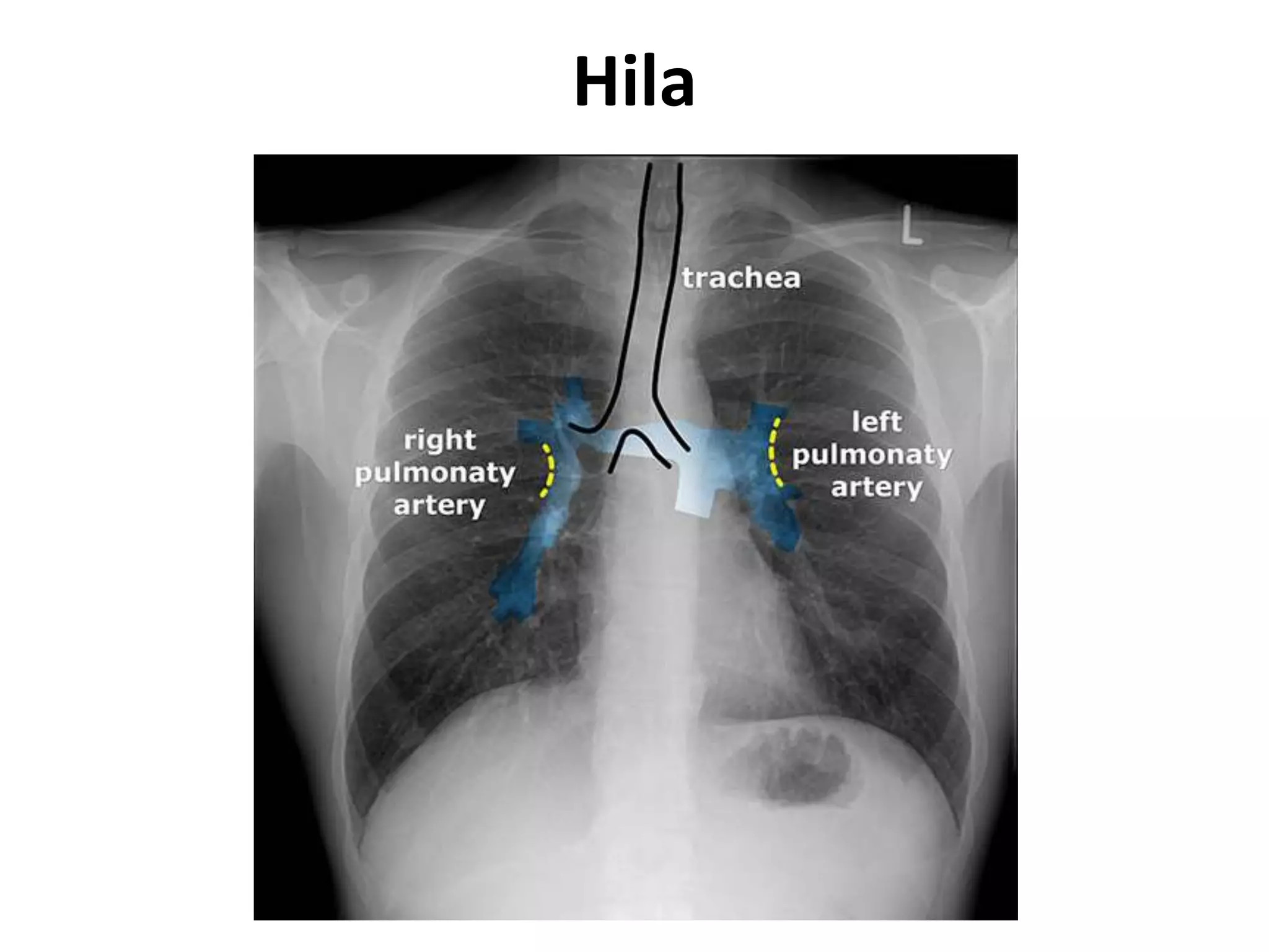 Chest X-rays for Undergraduates | PPTX