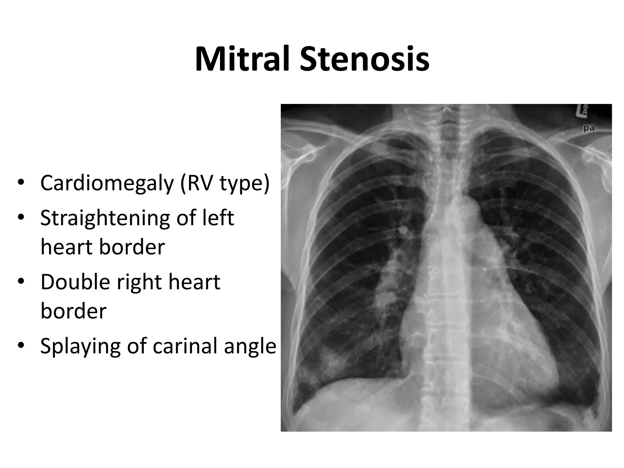 Chest X-rays for Undergraduates | PPTX
