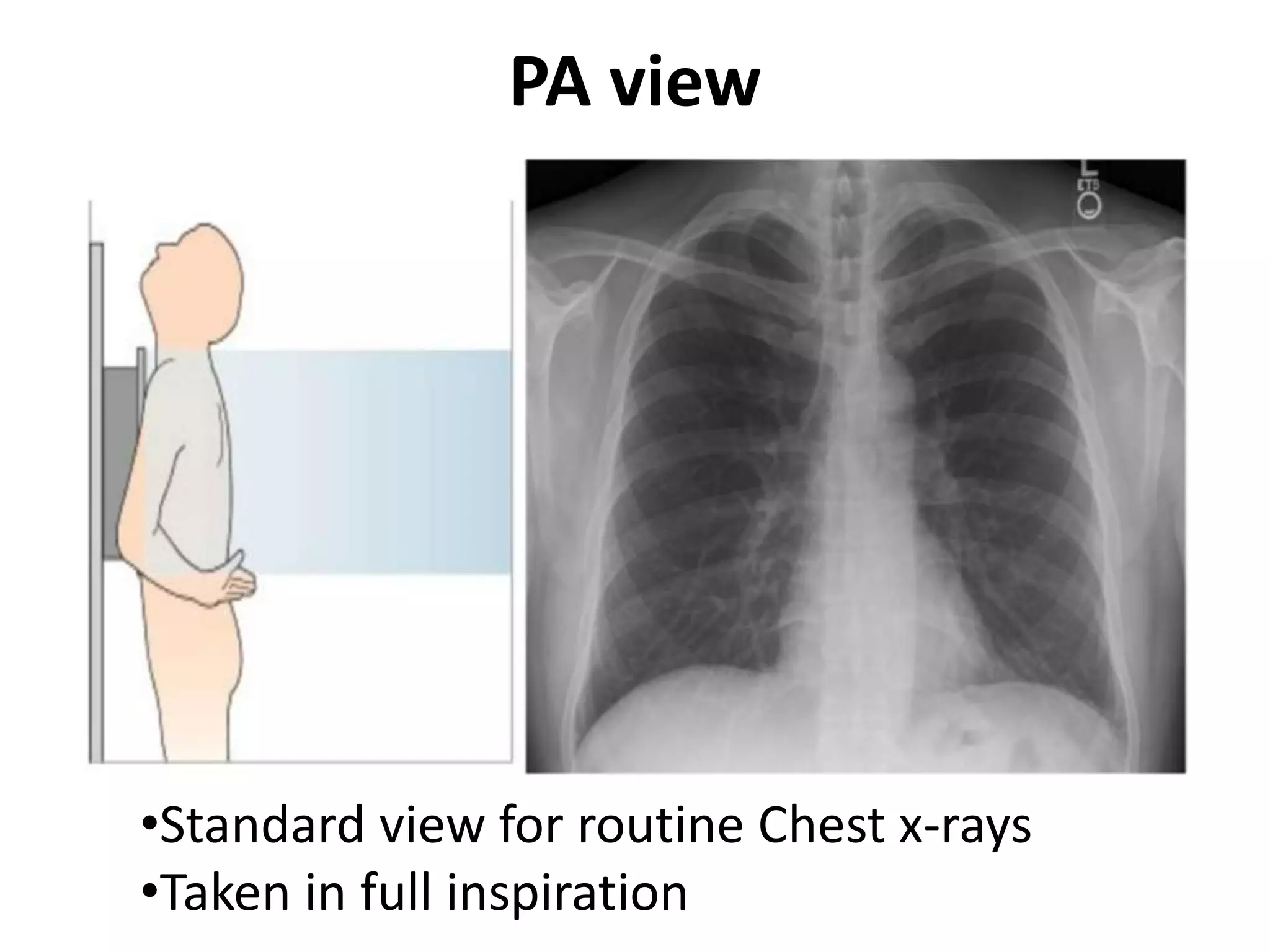 Chest X-rays for Undergraduates | PPTX