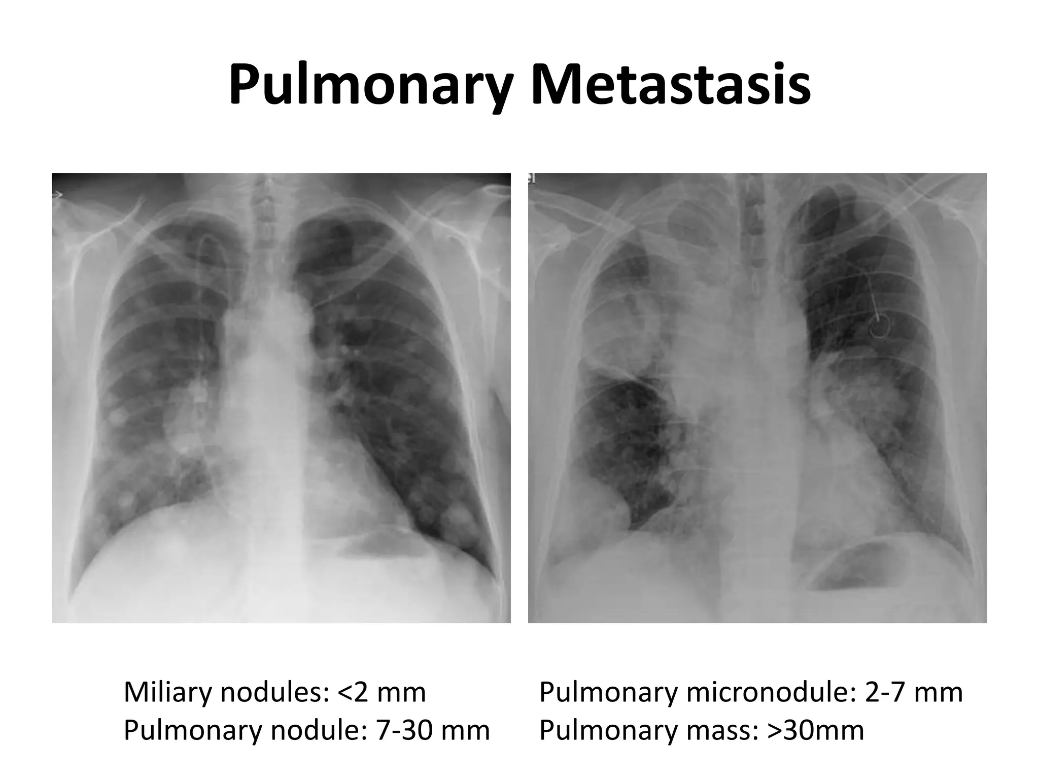 Chest X-rays for Undergraduates | PPTX