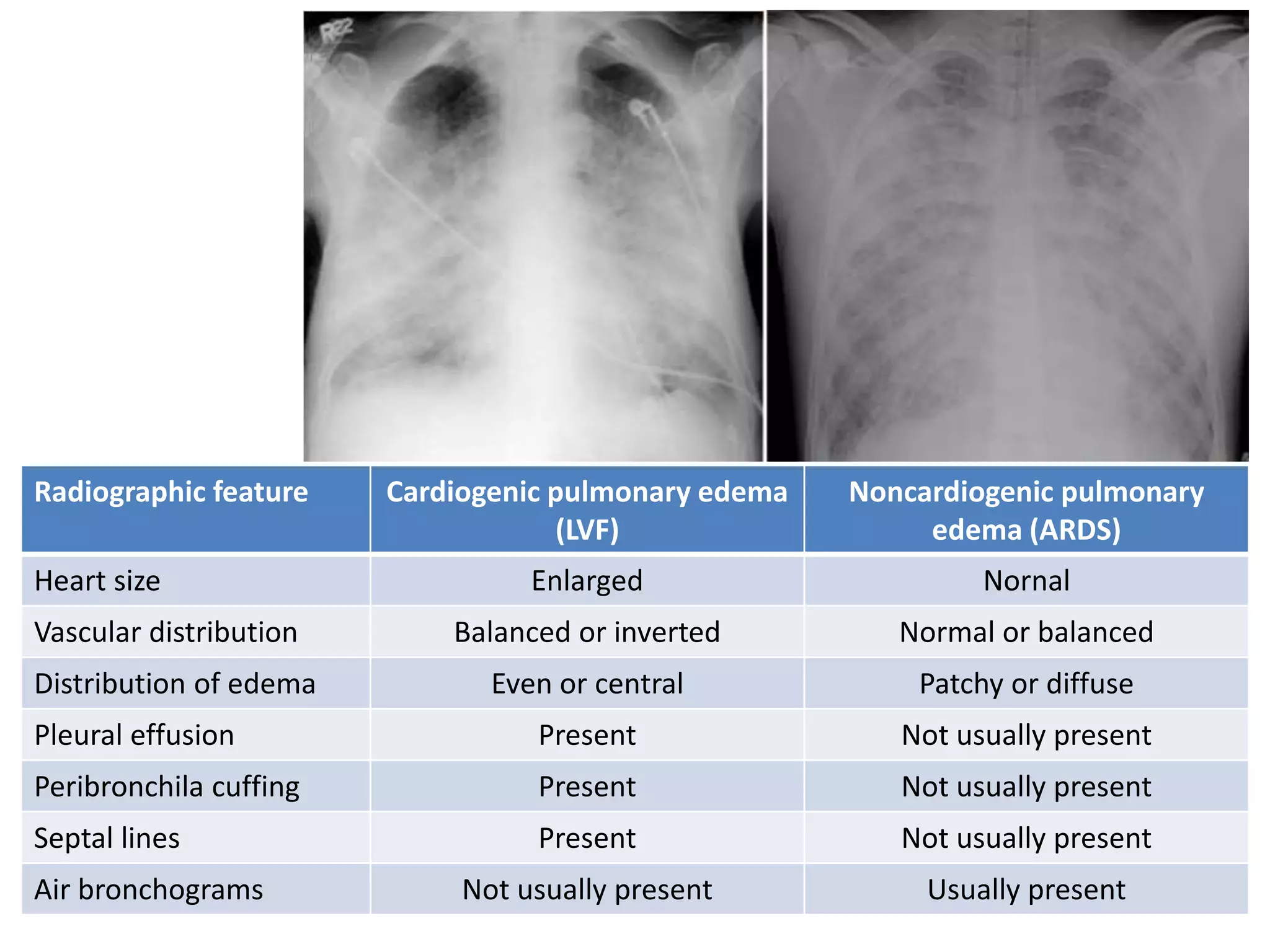 Chest X-rays for Undergraduates | PPTX