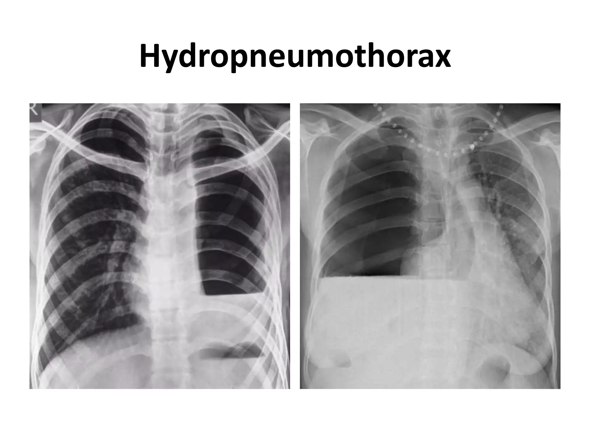 Chest X-rays for Undergraduates | PPTX