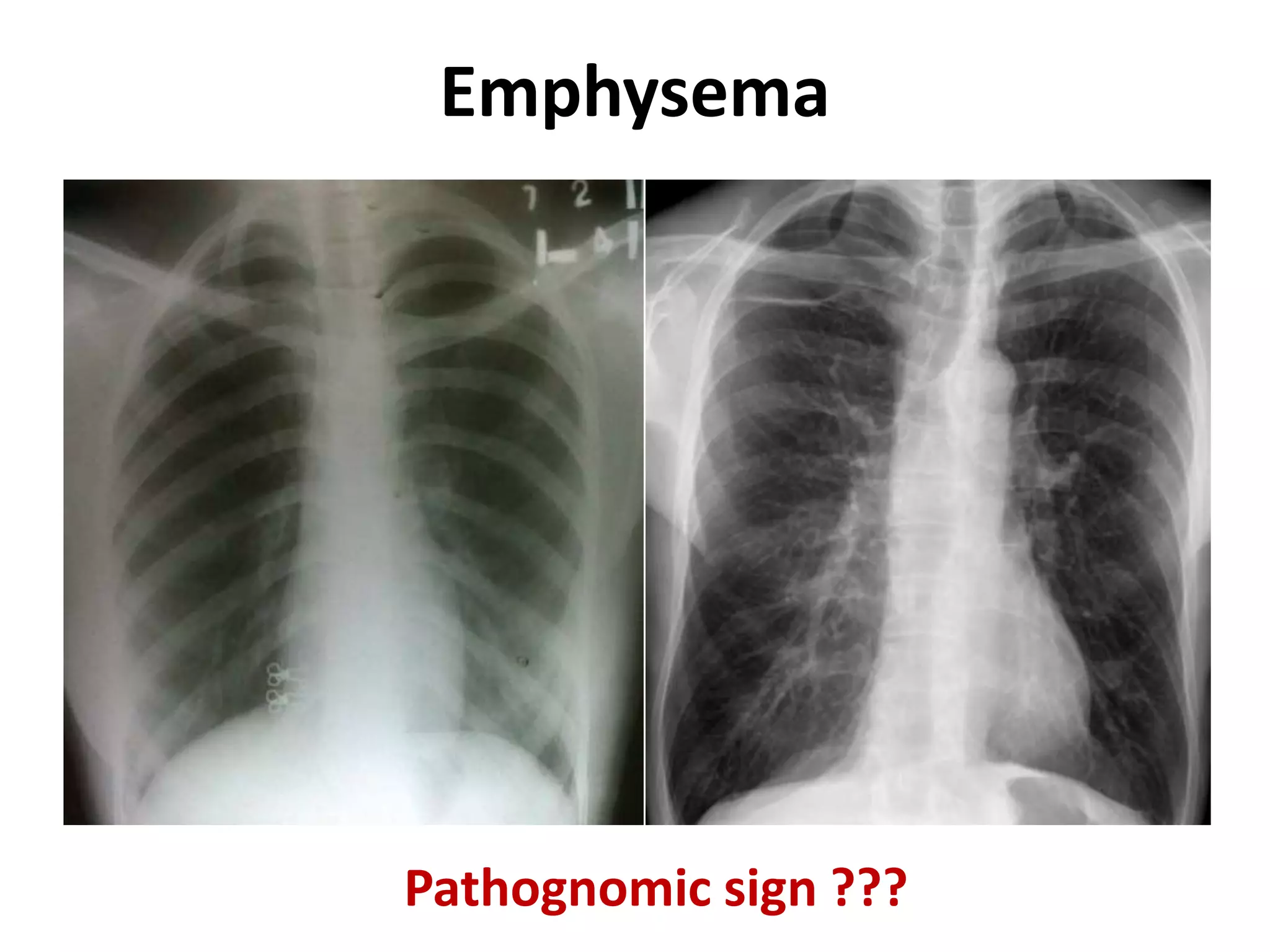 Chest X-rays for Undergraduates | PPTX