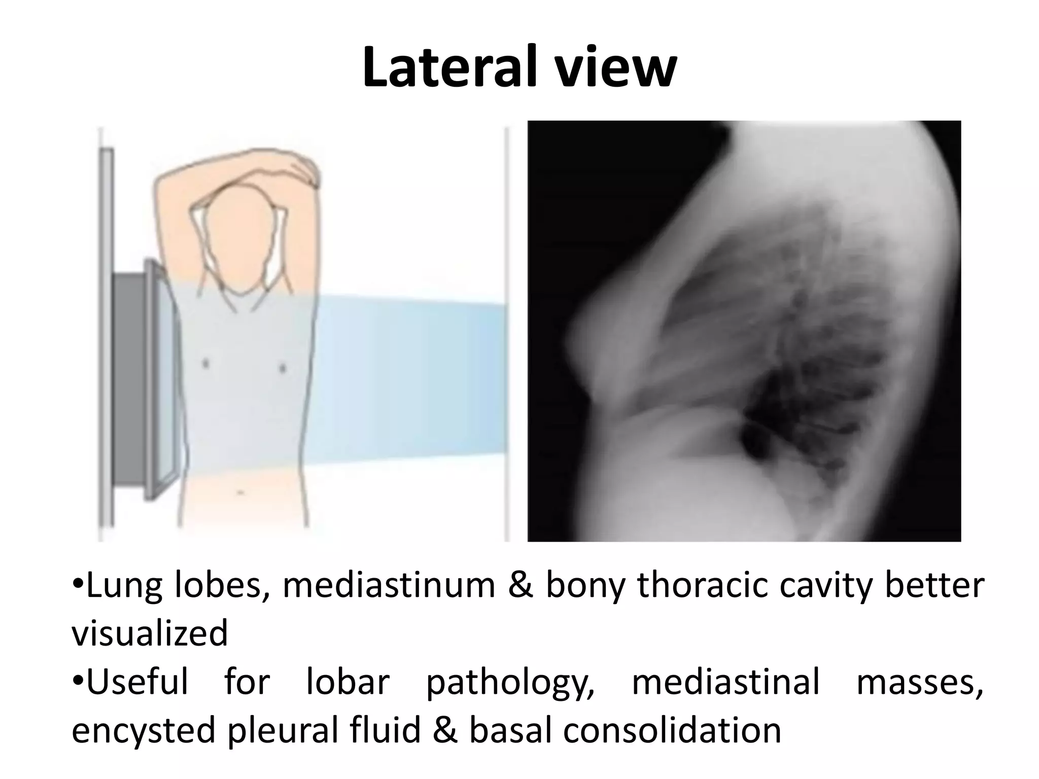 Chest X-rays for Undergraduates | PPTX