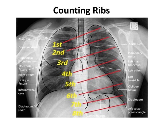Chest X-rays for Undergraduates | PPTX